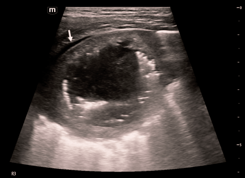 lung POCUS Archives - POCUS Journal