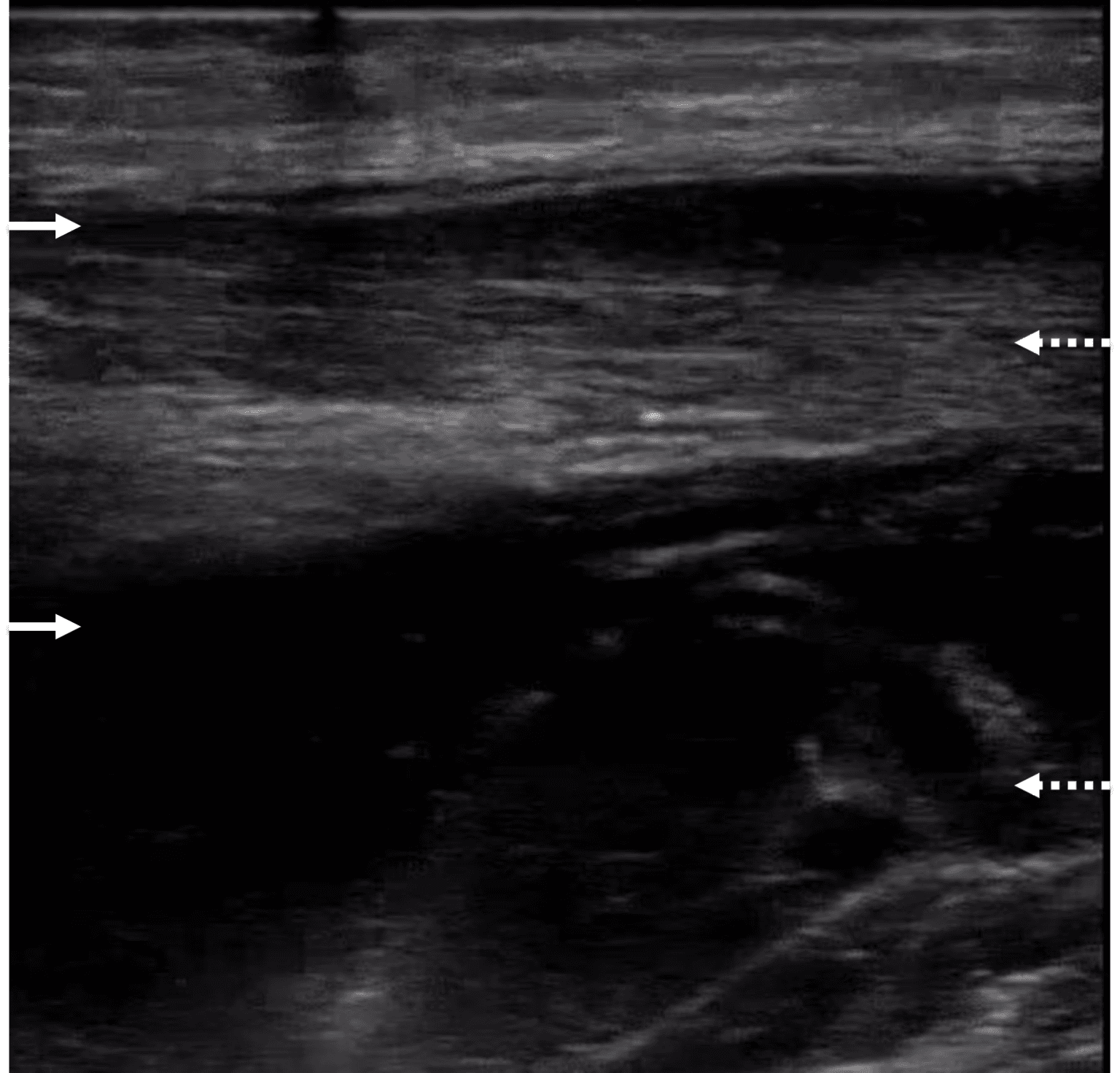 Diagnosis and Treatment of a Morel-Lavallee Lesion via Point of Care ...