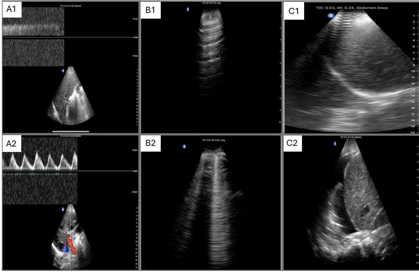 Subclinical Congestion Evaluated by Point of Care Ultrasound (POCUS) at ...