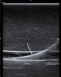 Sonographic Detection of Iatrogenic Carotid Artery Guidewires During ...