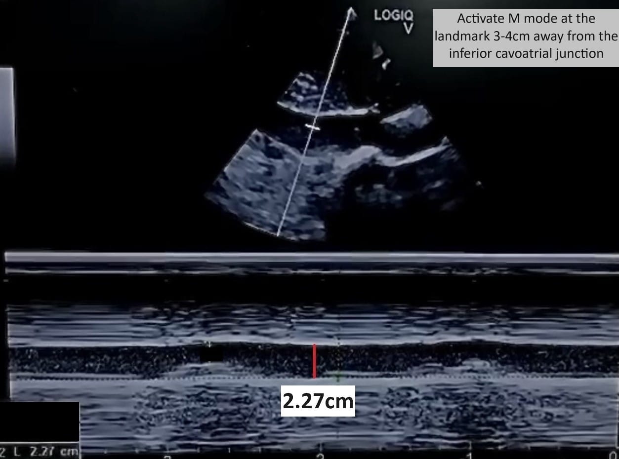 Venous Excess Ultrasound (VExUS) Grading to Assess Perioperative Fluid ...
