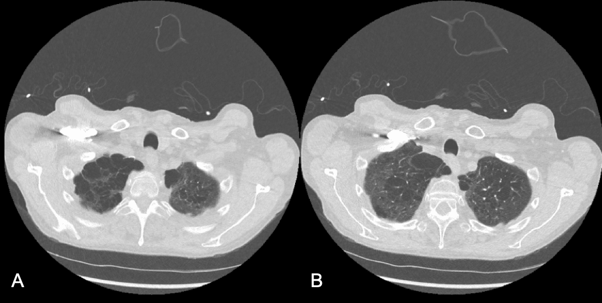Lung Point in a Case of Bronchoscopy Lung Volume Reduction: Consider ...