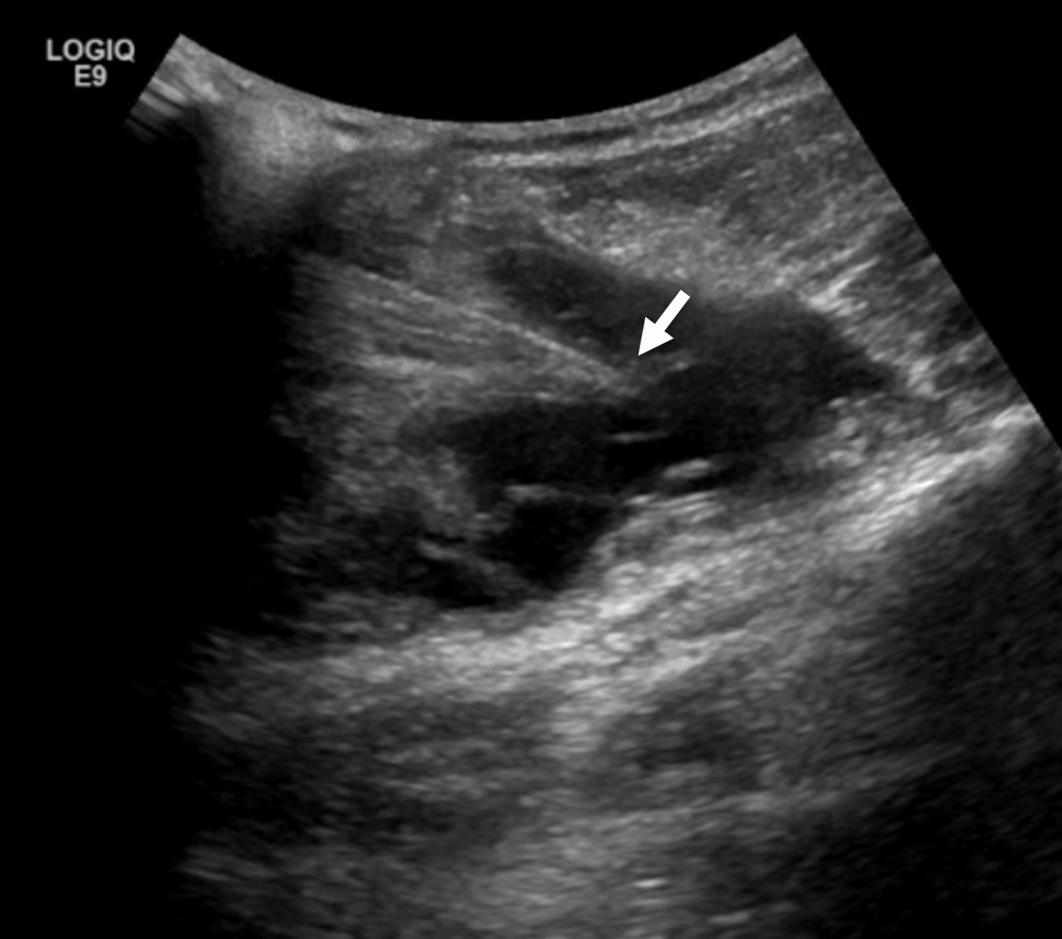 Diagnosis and Treatment of a Morel-Lavallee Lesion via Point of Care ...