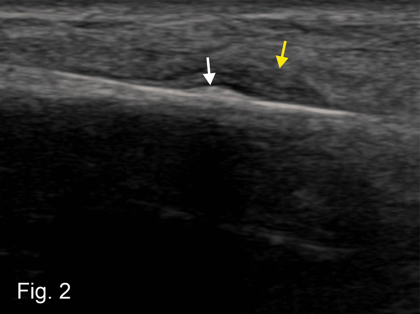 Diagnosis of a Stress Fracture Of a Metatarsal Bone with Point of Care ...