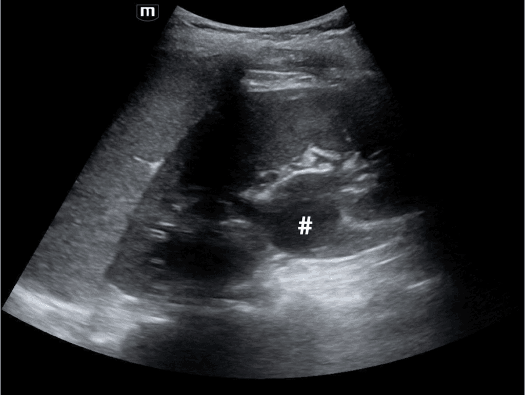 Rare Cause of Pediatric Abdominal Pain Diagnosed on Point of Care ...