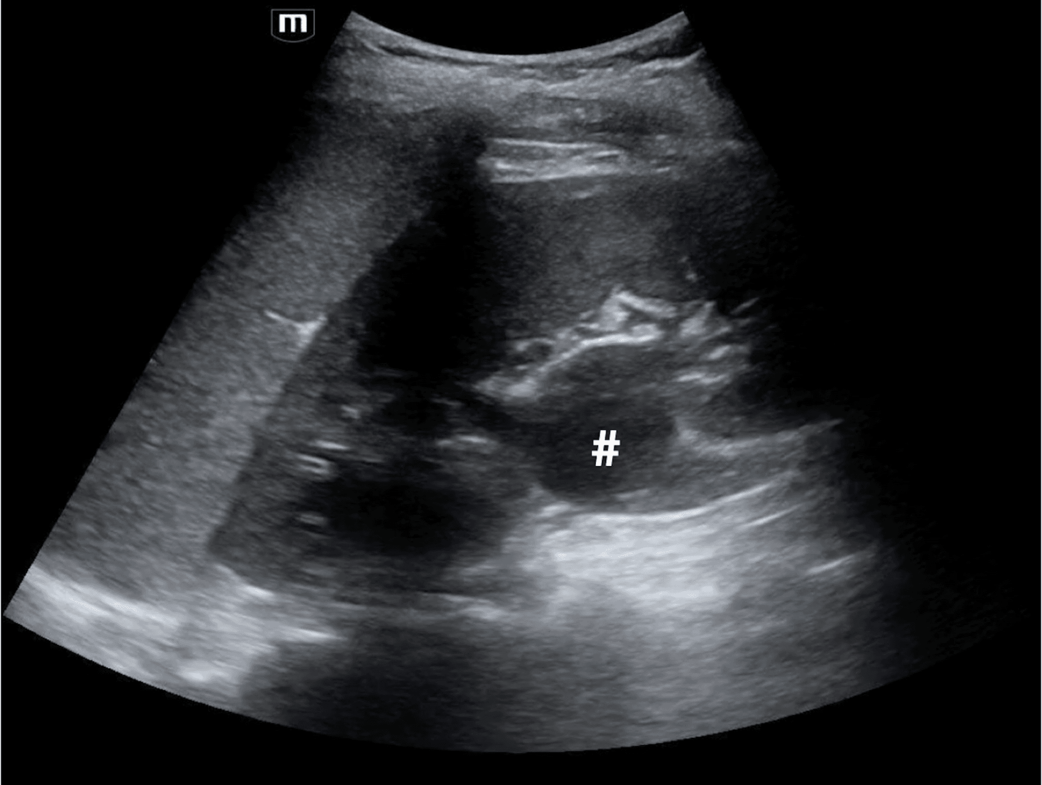 Parotid Sialolithiasis Diagnosed on Point of Care Ultrasound (POCUS ...