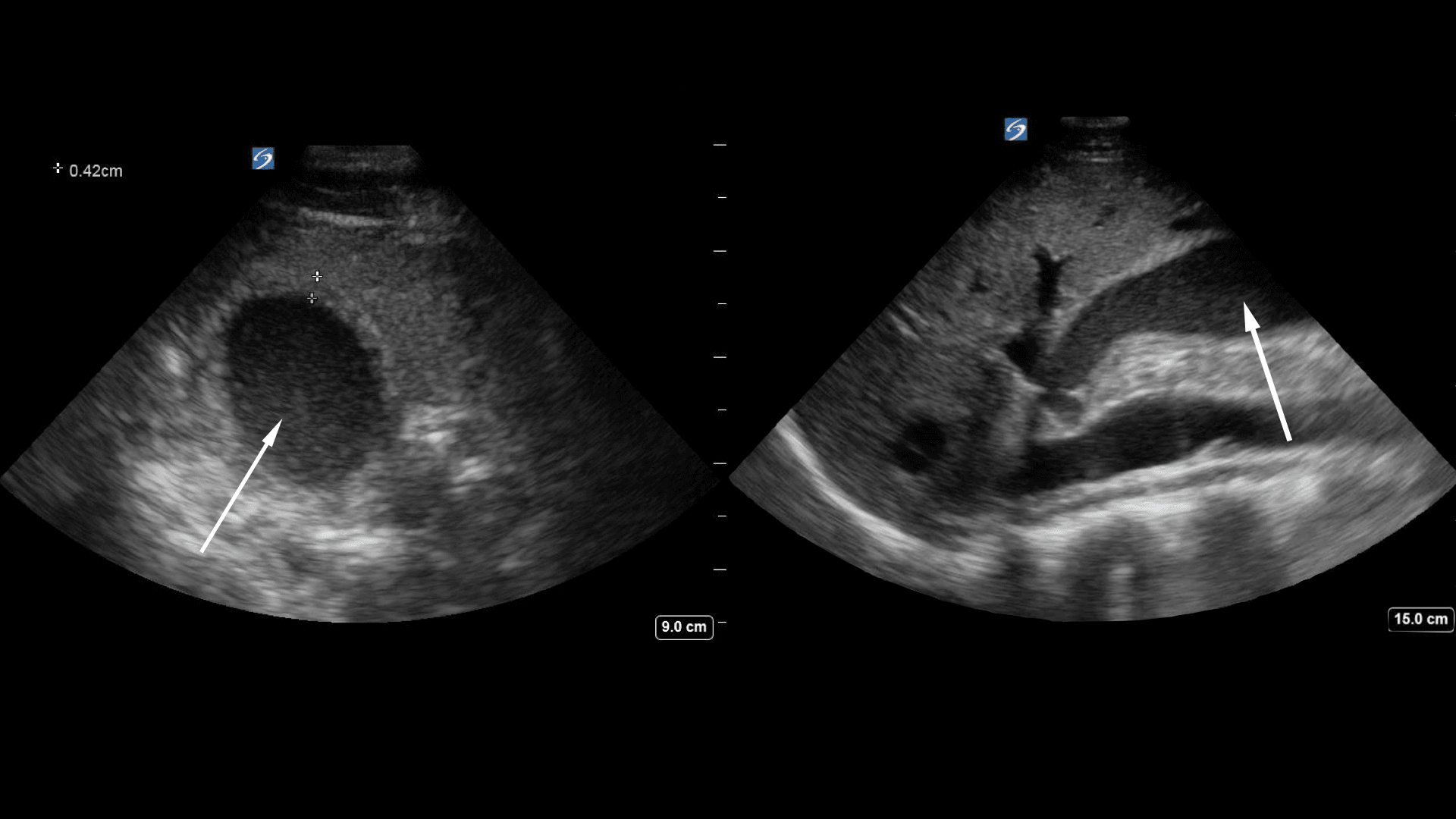 A Young Man with Chest Pain - POCUS Journal