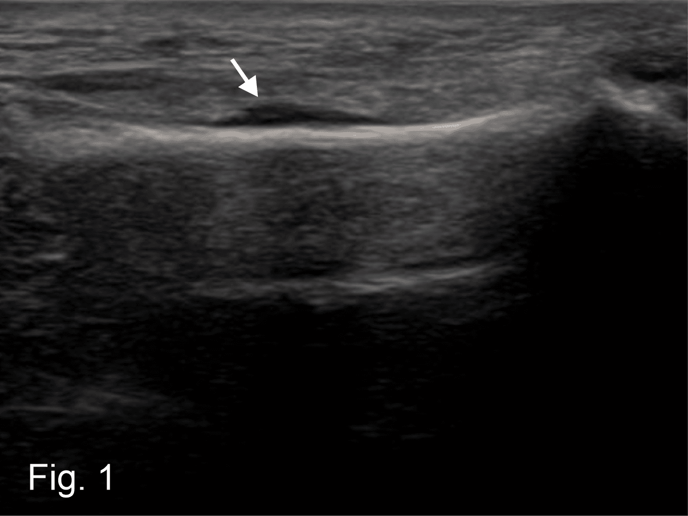 Diagnosis of a Stress Fracture Of a Metatarsal Bone with Point of Care ...