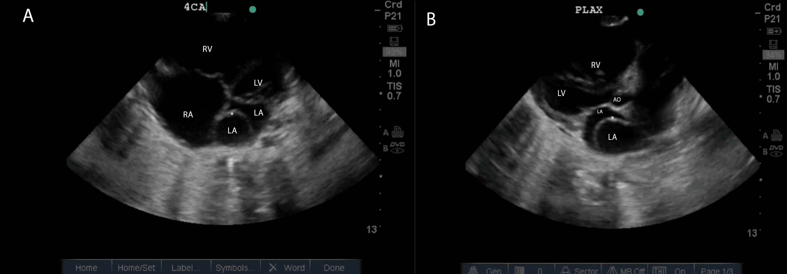 Cor Triatriatum in a Pediatric Patient, Accidental Point of Care Ultrasound (POCUS) Discovery ...