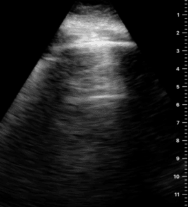 Rib Reverberation: An Important New Artifact in Lung Ultrasound - POCUS ...