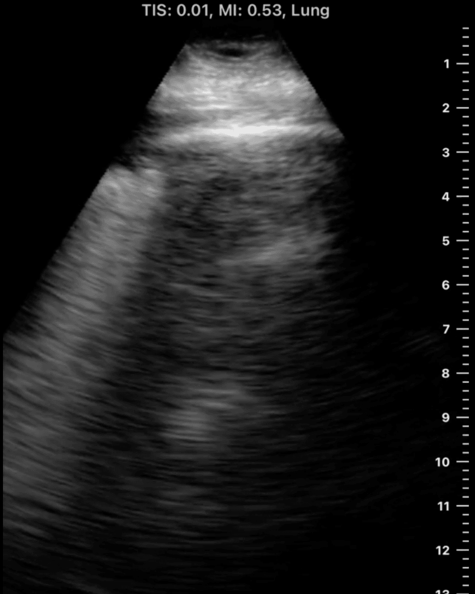 Rib Reverberation: An Important New Artifact in Lung Ultrasound - POCUS ...