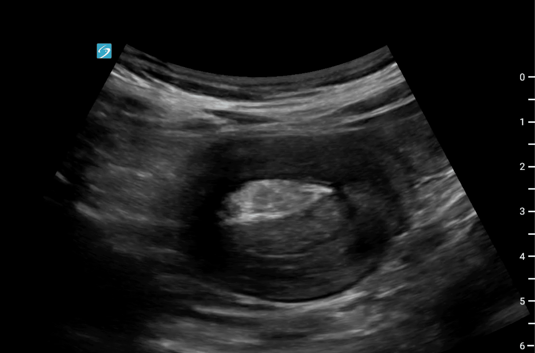 Man with Abdominal Bloating, Weight Loss - POCUS Journal