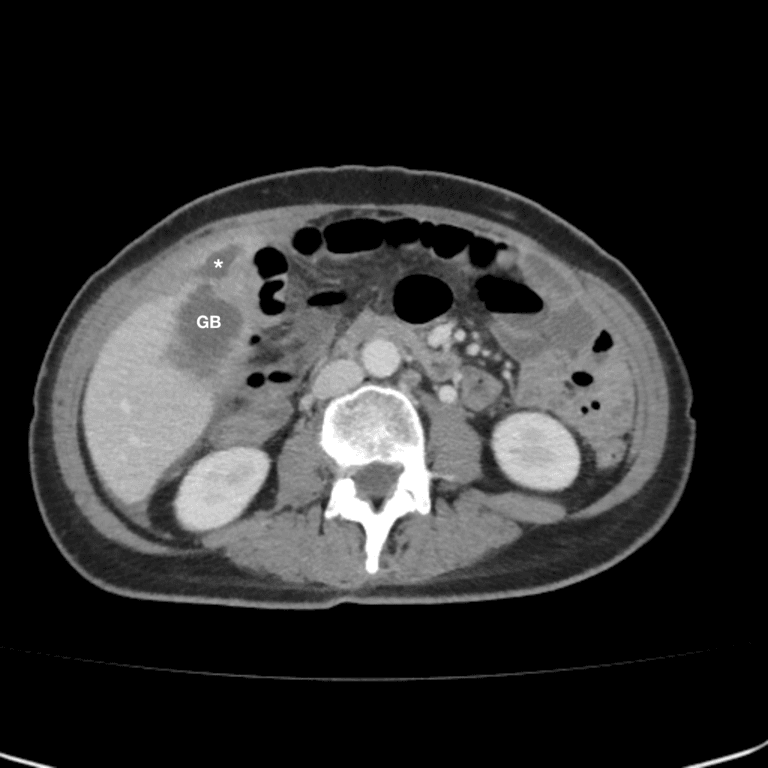 Point-of-Care Ultrasound for the Diagnosis of Colon Cancer - POCUS Journal