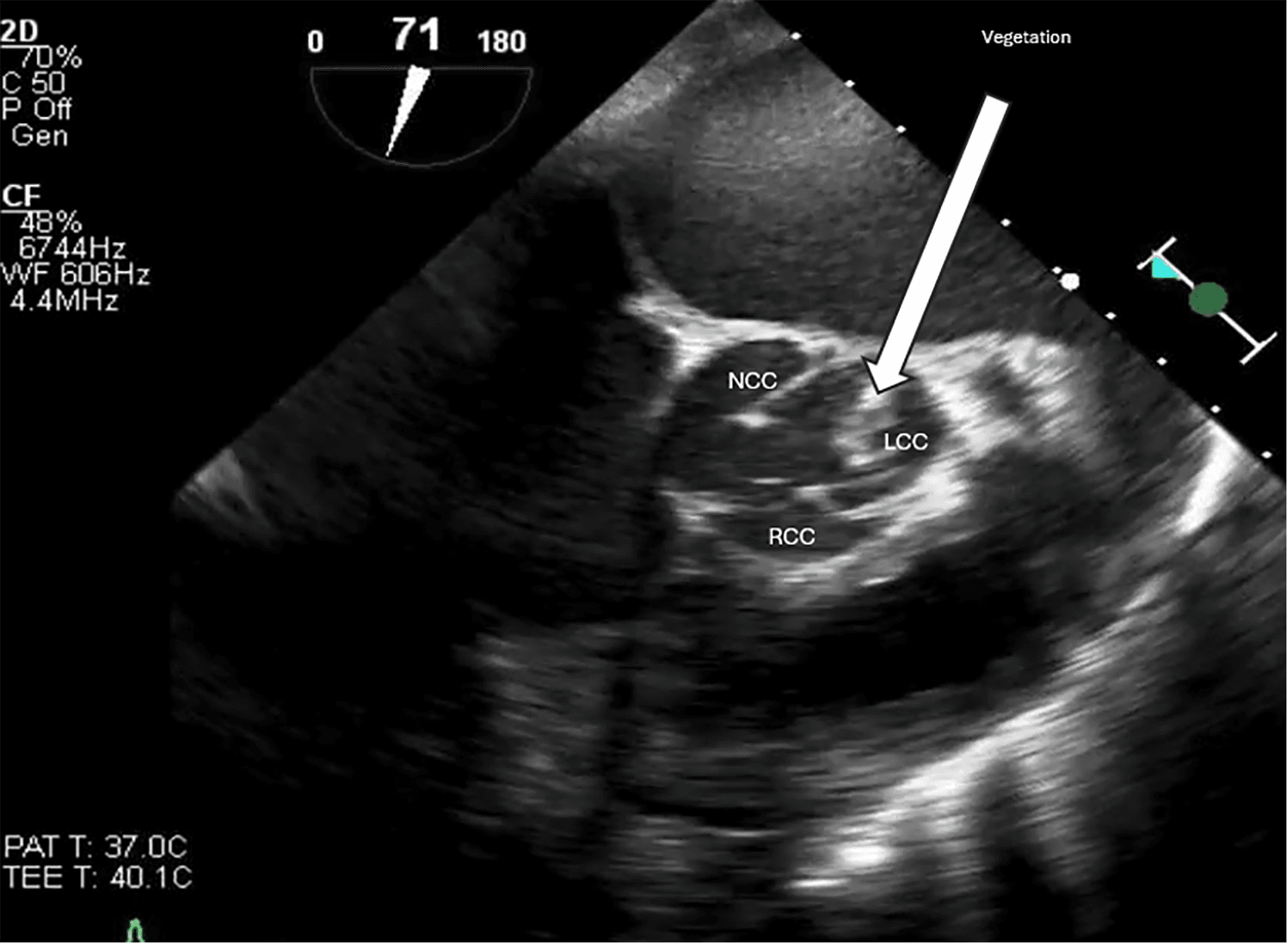 Cardiac Point of Care Ultrasound (POCUS) Used to Diagnose Infective ...