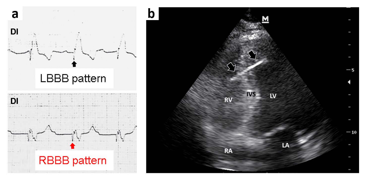 Perforation of the Interventricular Septum by a Temporary Transvenous ...