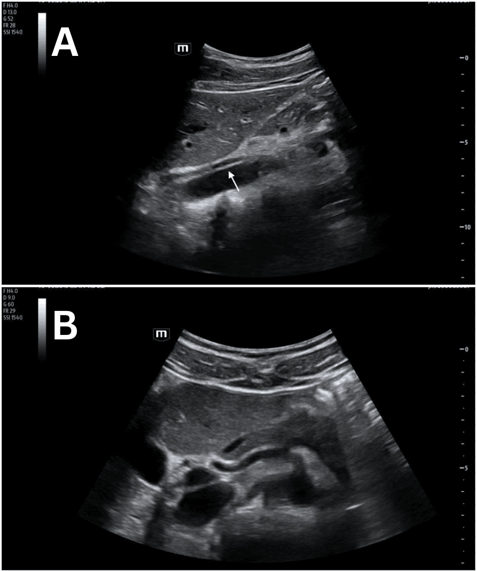 A Point of Care Ultrasound (POCUS) Artifact Mimicking an Aortic ...