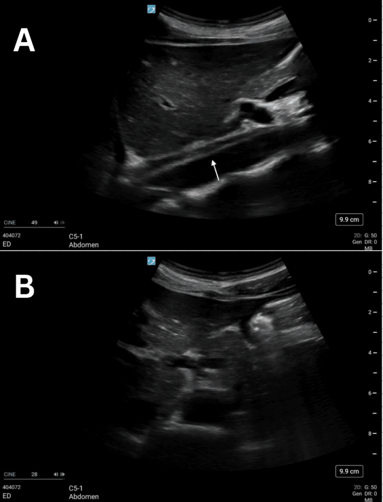 A Point of Care Ultrasound (POCUS) Artifact Mimicking an Aortic ...