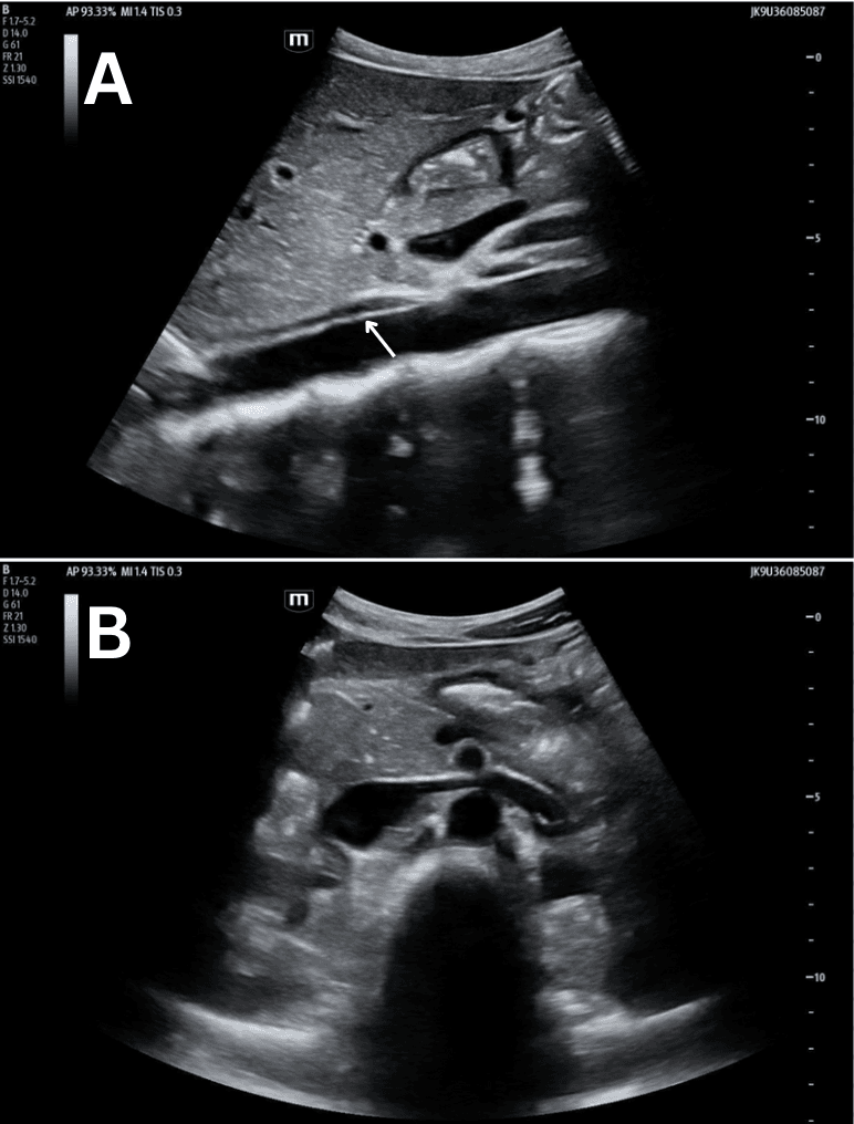 A Point of Care Ultrasound (POCUS) Artifact Mimicking an Aortic ...
